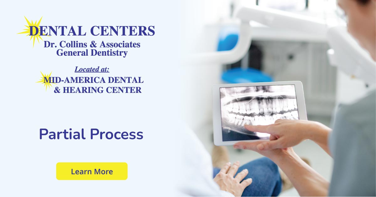 Partial Process | Mid America Dental Center